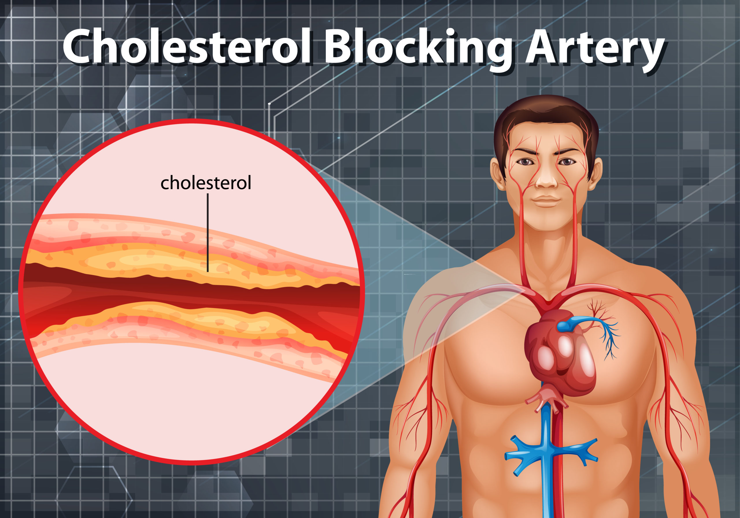 Main Causes of Cholesterol Main Causes of Cholesterol